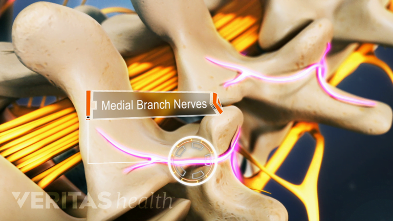 Medial Branch Nerve Blocks - Dermatomes Chart and Map