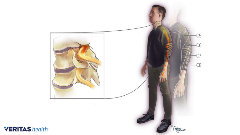 Radiculopathy Radiculitis And Radicular Pain - Dermatomes Chart and Map